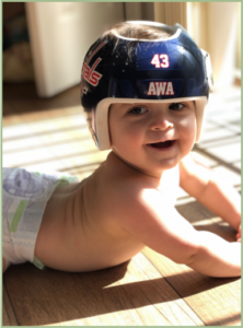 Cranial Helmets | Human Technology Prosthetics & Orthotics