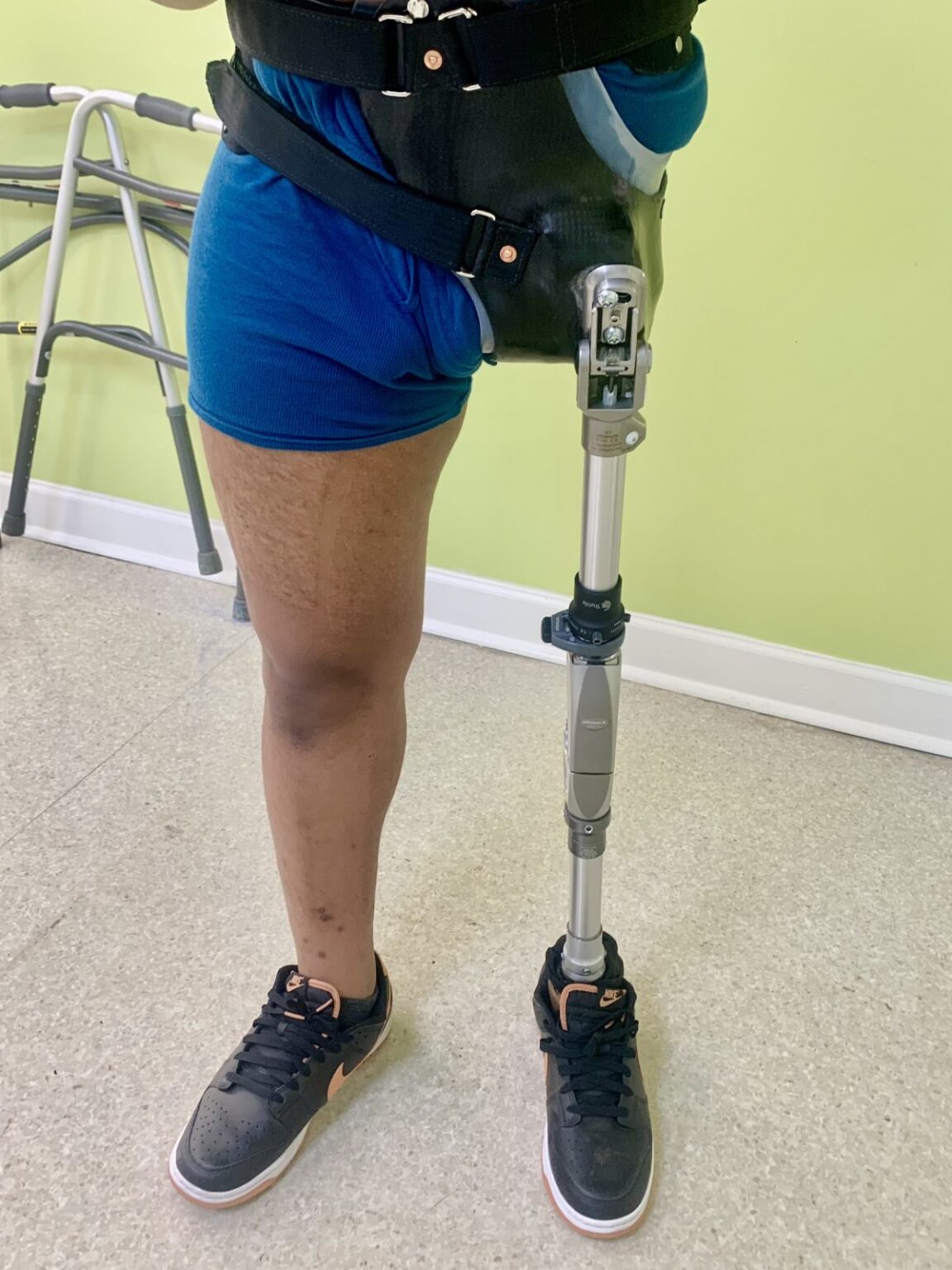 Hip Disarticulation & Hemipelvectomy Amputees | Human Tech