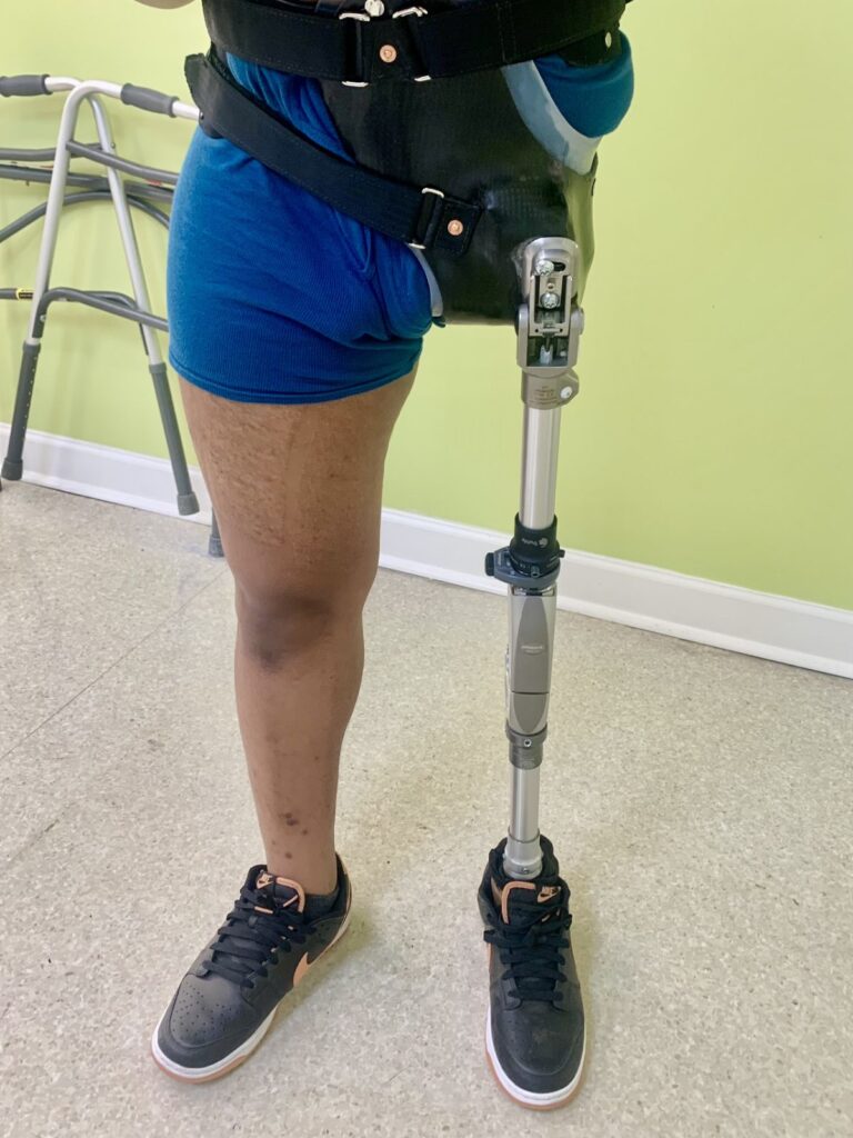 Hip Disarticulation & Hemipelvectomy Amputees | Human Tech