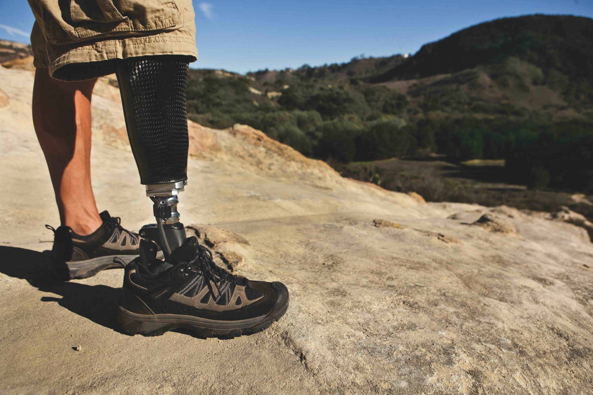 Managing Limb Loss | Self-Care & Acceptance After an Amputation