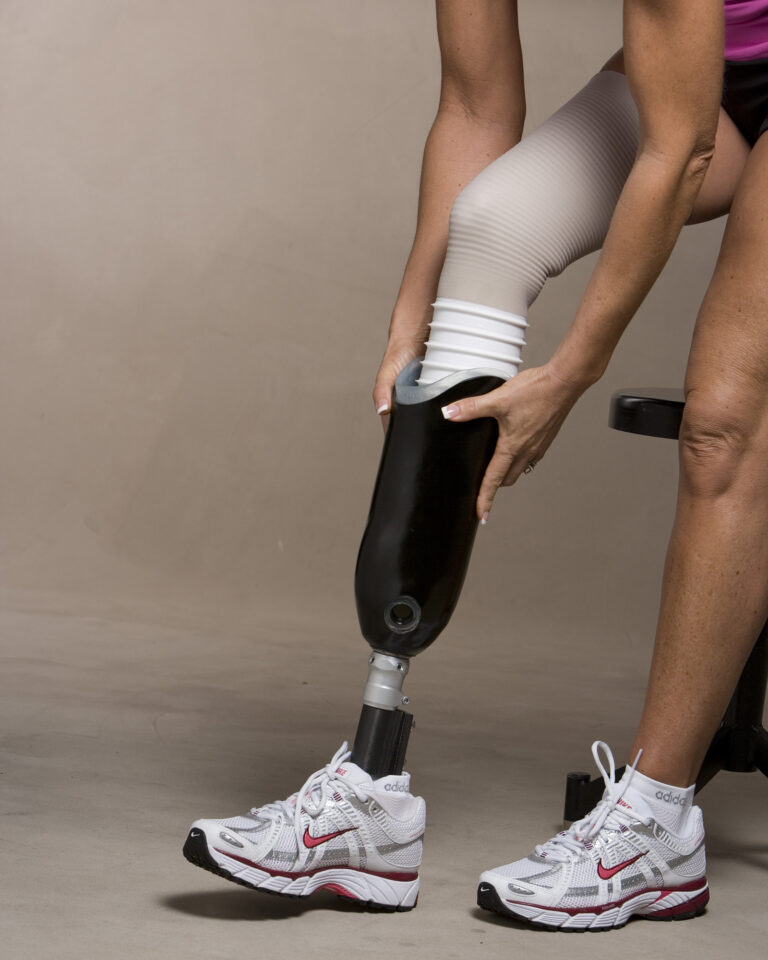 Prosthetic Suspensions: A Guide to Mobility and Comfort